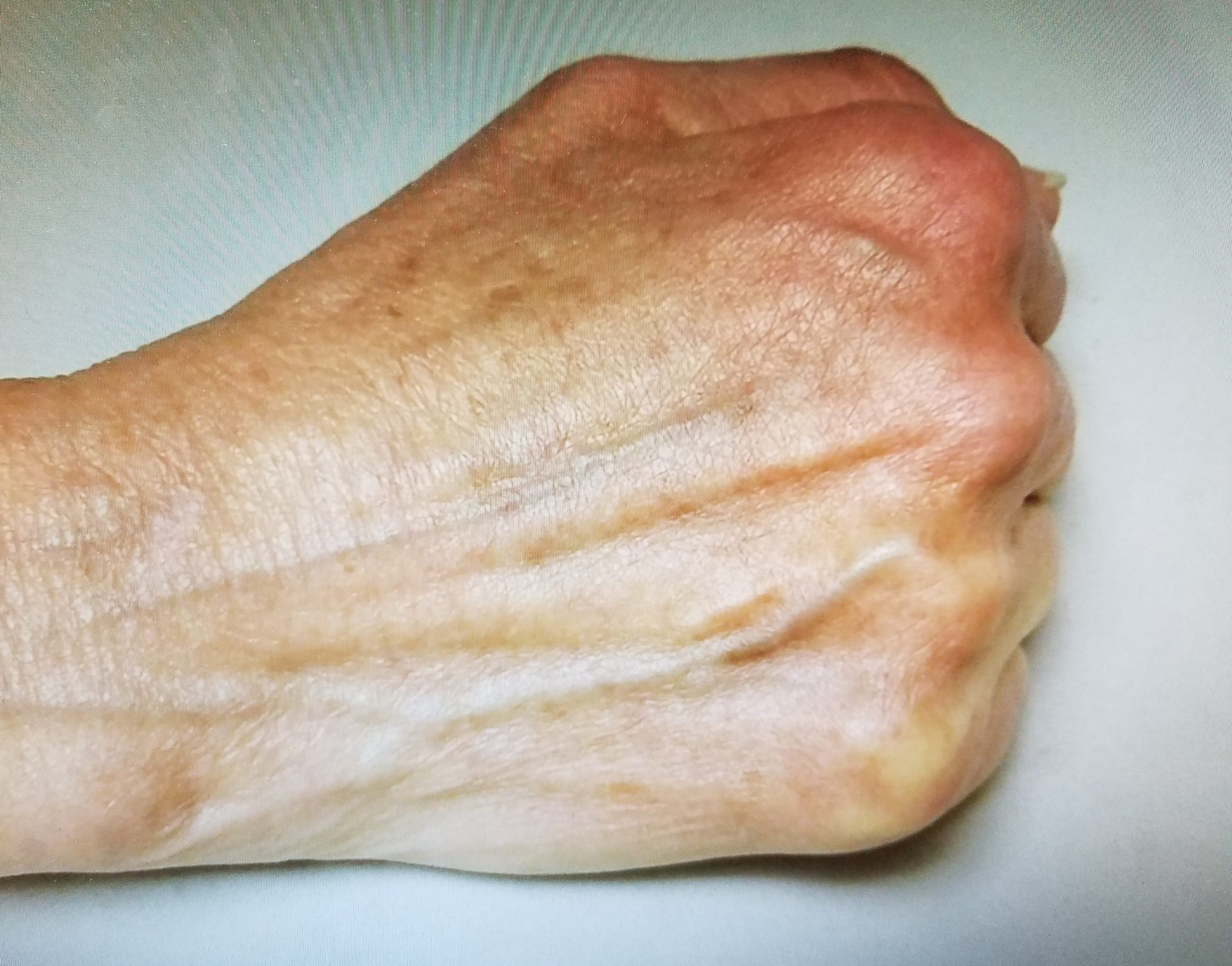 “Handy Work” Hand Rejuvenation - Sutton Dermatology + Aesthetics