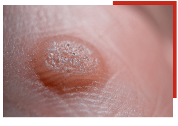 Warts Treatment, Lincoln, NE- Sutton Dermatology + Aesthetics